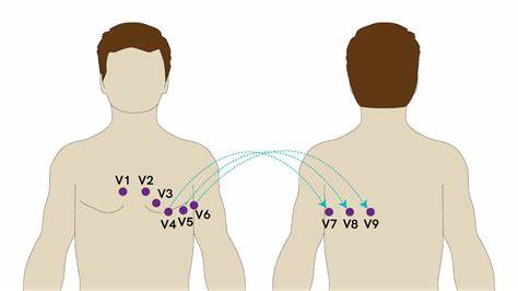 160,000 Posterior Heart Attacks Happen Every Year. Are You Missing ...